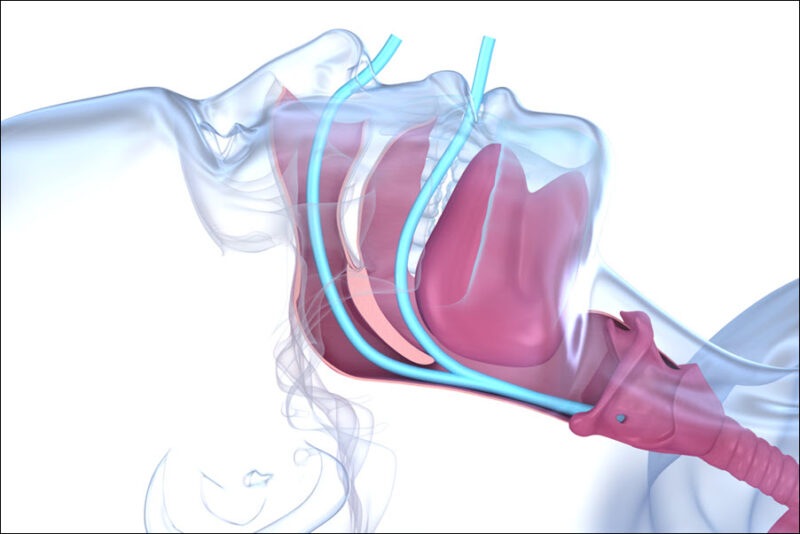 Sleep Apnea Dental Treatments Premier Dental Of Carlisle